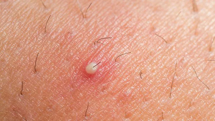 The One Thing You Should Never Put On An Ingrown Hair Ingrown Hair The One Thing You Should Never Put On An Ingrown Hair Ingrown Hair