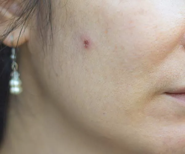 What Your Acne Is Trying To Tell You About Your Health - SHEfinds