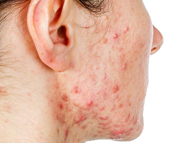 What Your Acne Is Trying To Tell You About Your Health - SHEfinds