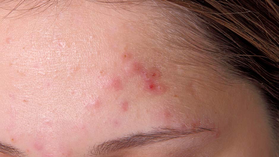 This $7 Pimple Hack Really Works! - SHEfinds