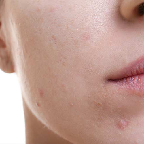 The One Food You Should Avoid At Breakfast Because It Clogs Pores ...