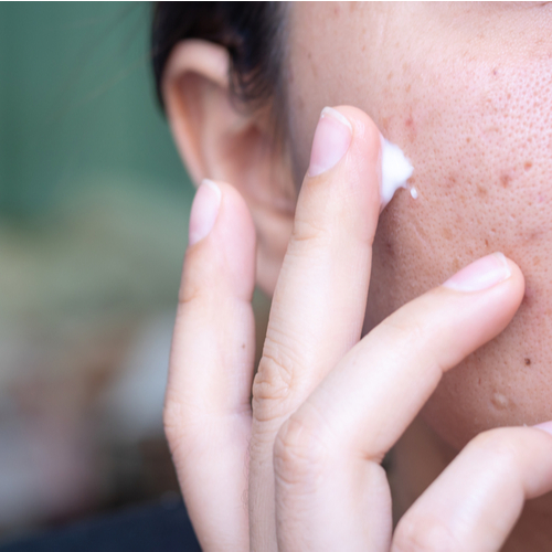 7 At-Home Remedies For When Zits Pop Up Out Of Nowhere, According To ...