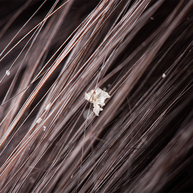 This Is Actually The Best Way To Banish Dandruff, According To Hair ...