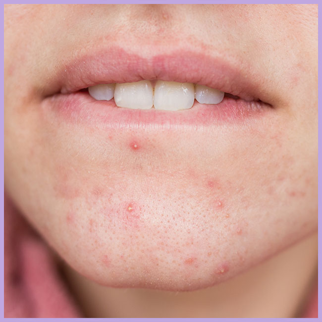 4 Foods You Should Stop Eating Immediately Because They Cause Acne ...