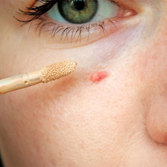 A Makeup Artist Tells Us How To Properly Cover And Conceal Zits - SHEfinds