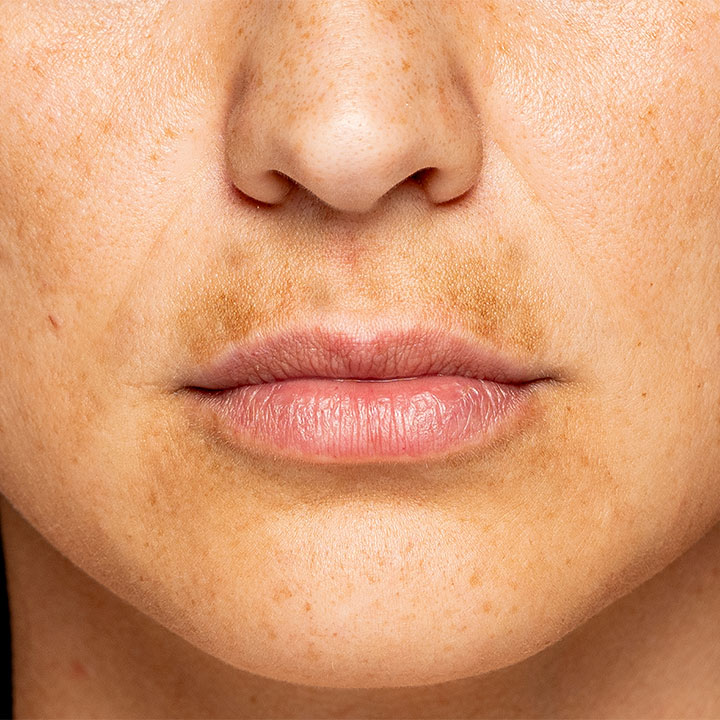A Dermatologist Tells Us The Best Treatments For Dark Spots, Once And ...