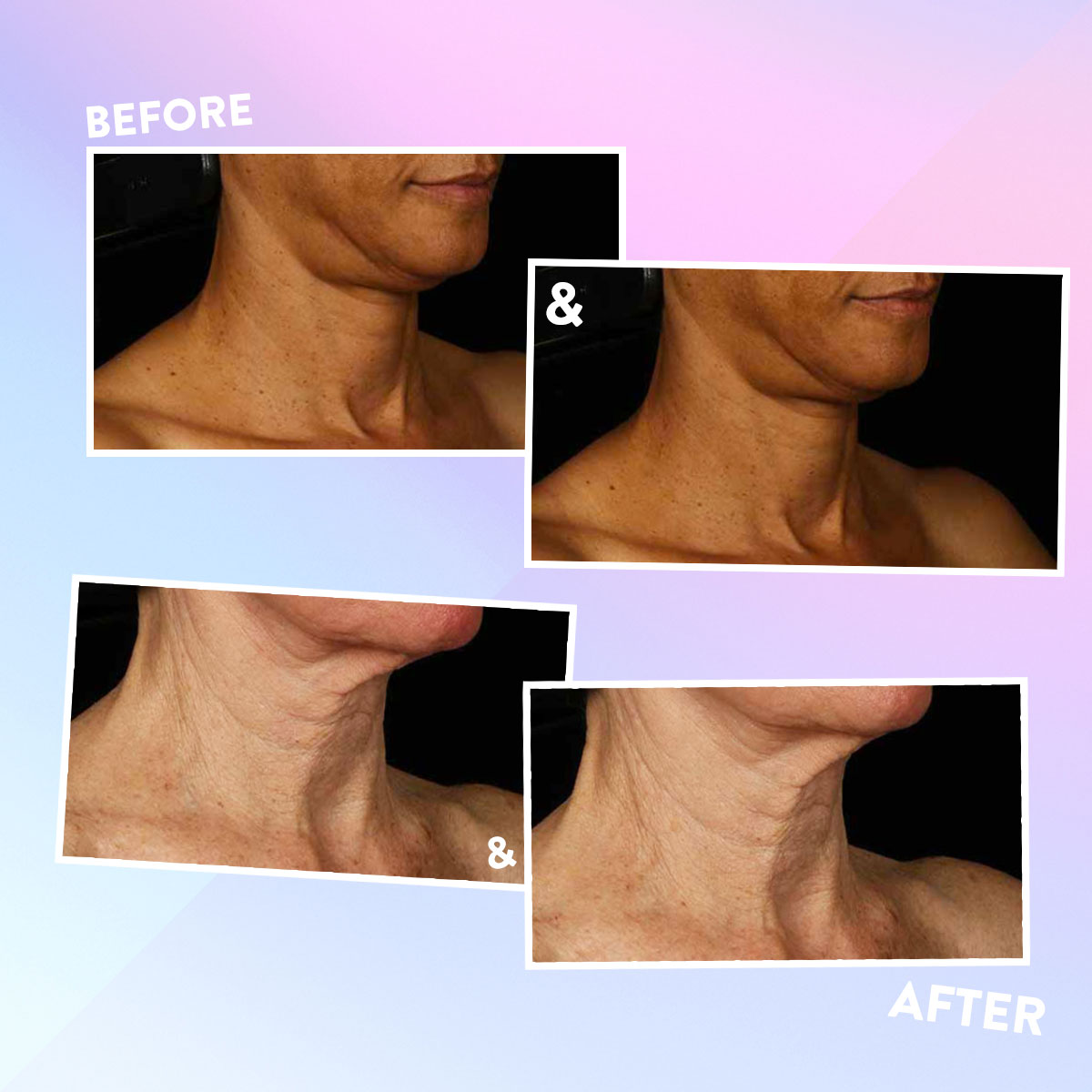 A Dermatologist Tells Us The Best Neck Corrector For A Firmer, More ...