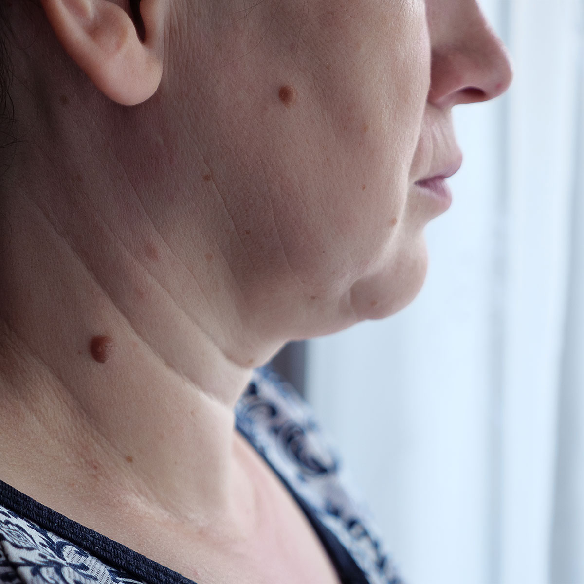 Dermatologists Recommend These Non-Surgical Treatments To Tighten ...