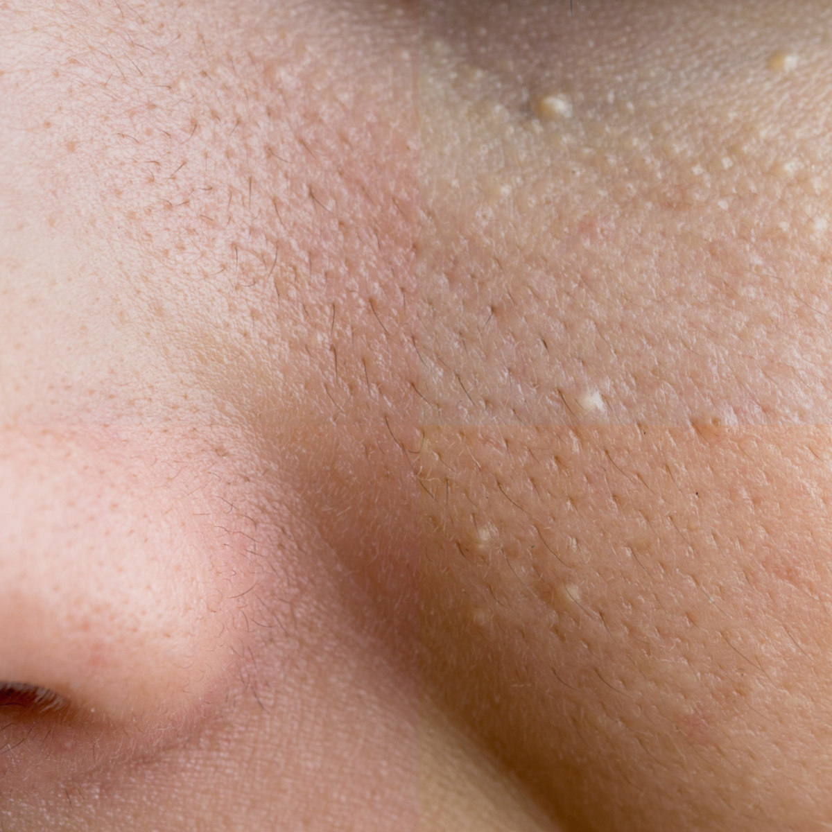 What Are Milia Spots? A Dermatologist Explains The Common Aging Skin ...