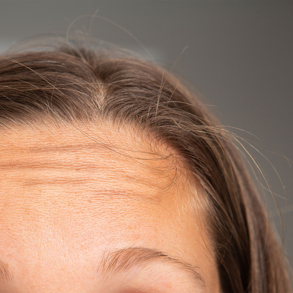 2 Natural Treatments To Stimulate Growth At The Hairline, According To ...
