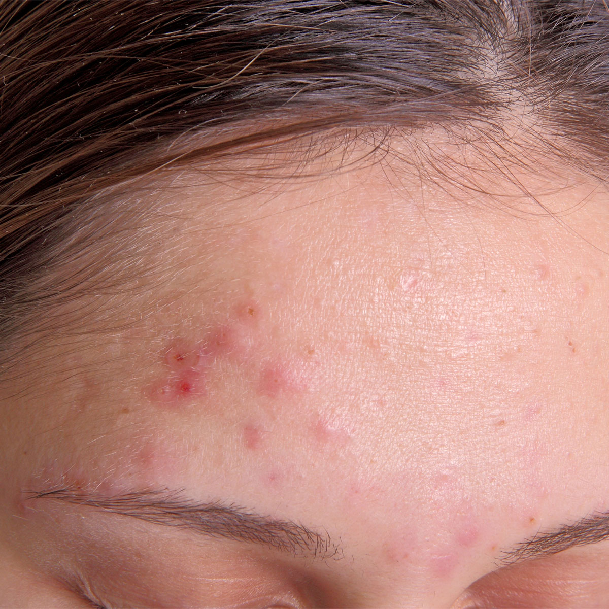 Dermatologists Share 5 Foods That Make Your Skin Puffy And Acne-Prone ...