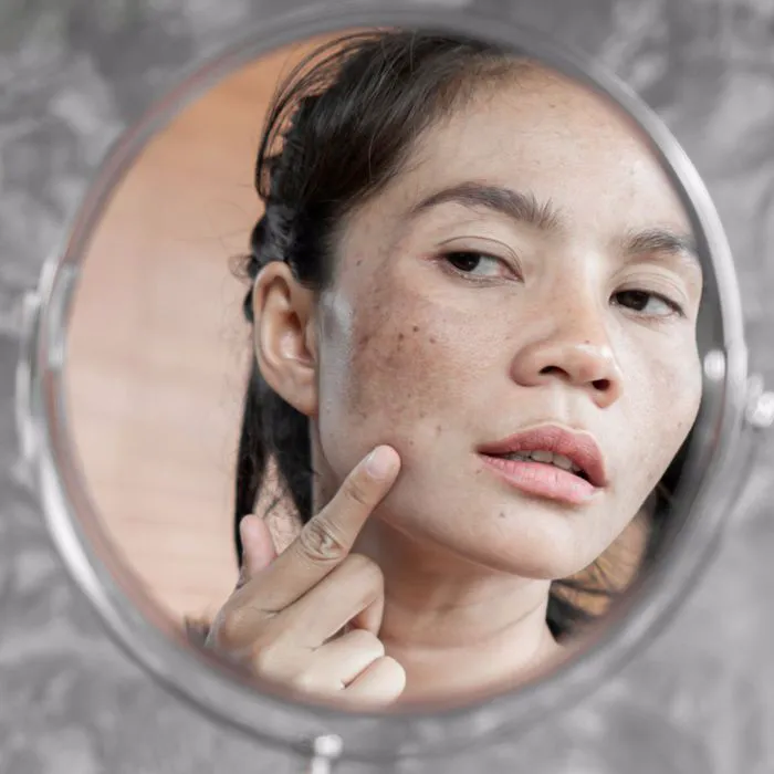 Dermatologists Share 5 Foods That Make Your Skin Puffy And Acne-Prone ...