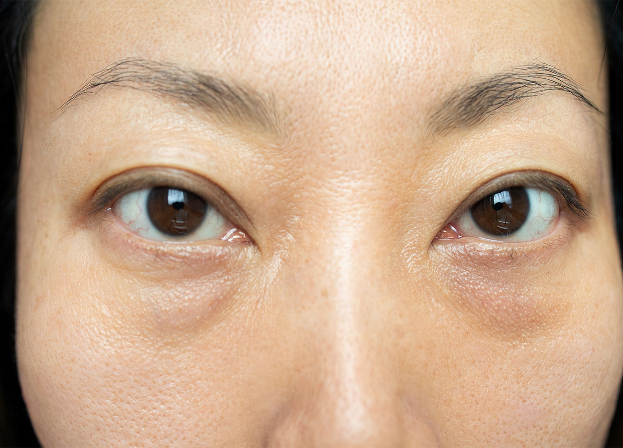 Over 40 With Puffy Under Eyes? A Derm Shares The Best Treatments To Get ...