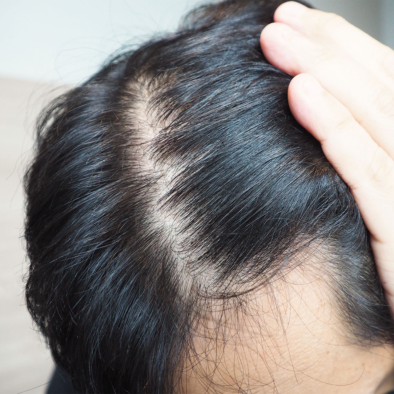 What Are Milia Spots? A Dermatologist Explains The Common Aging Skin ...